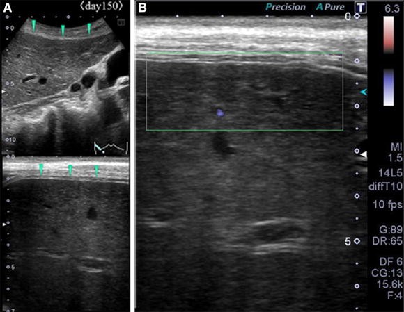 Elderly Fitz-Hugh–Curtis syndrome observed with superb microvascular ...