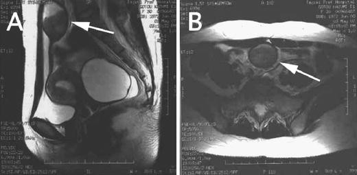 Laparoscopic Excision Of Urachal Cyst Found At Preoperative Examination