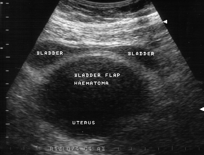 Conservative laparoscopic treatment of post-caesarean section bladder ...