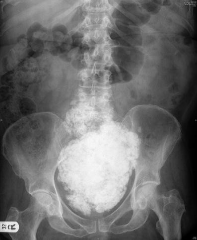 Calcifying uterine leiomyoma invading the urinary bladder | SpringerLink