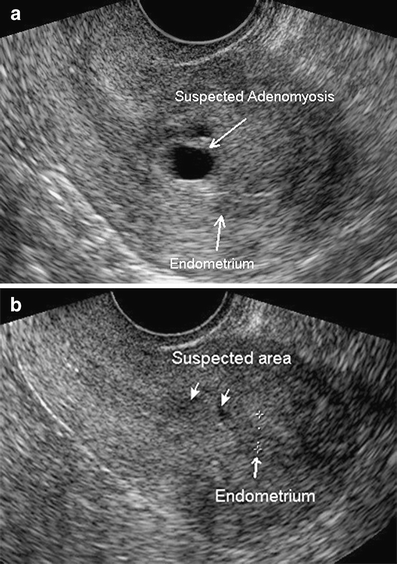 Luteal phase transvaginal scan examinations have better diagnostic ...