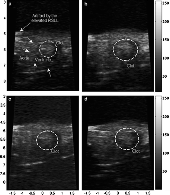 Pulse Inversion Chirp Coded Tissue Harmonic Imaging (PI-CTHI) of ...