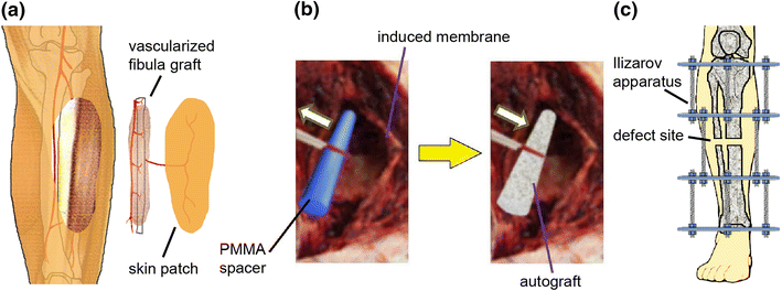 Vascularization in Bone Tissue Engineering Constructs | SpringerLink