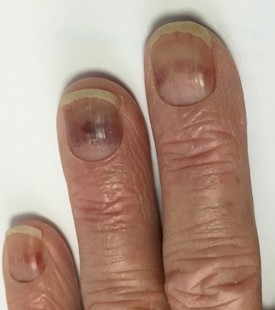 A double-blind, randomised trial of a polyphenolic-rich nail bed balm ...