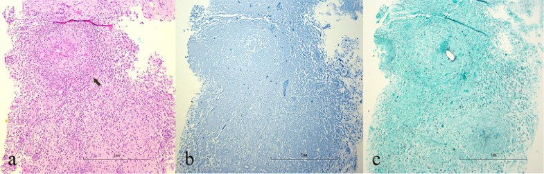 Granulomatous mastitis: etiology, imaging, pathology, treatment, and ...
