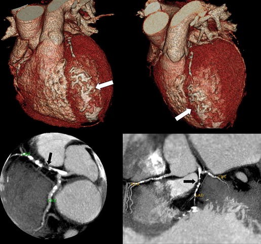 Myocardial calcification and subendocardial fatty replacement of the ...