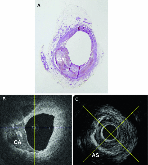 IVUS-based imaging modalities for tissue characterization: similarities ...