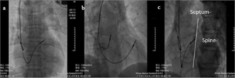 A randomized comparison of fluoroscopic techniques for implanting ...