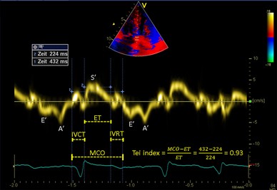 Value of tissue Doppler-derived Tei index and two-dimensional speckle ...
