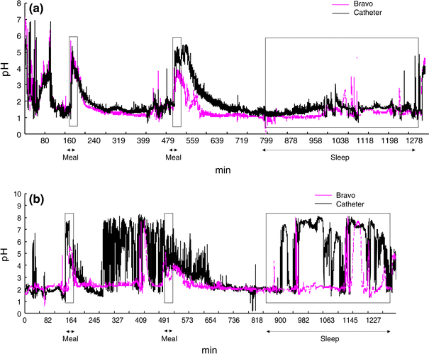 A Novel Placement Method of the Bravo Wireless pH Monitoring Capsule ...