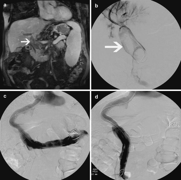 Transjugular Intrahepatic Portosystemic Shunt with Thrombectomy for the ...