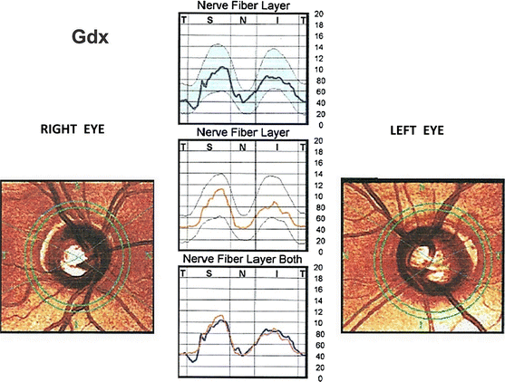Pattern electroretinogram (PERG) in the early diagnosis of normal ...