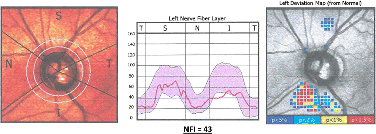 Pattern electroretinogram (PERG) in the early diagnosis of normal ...