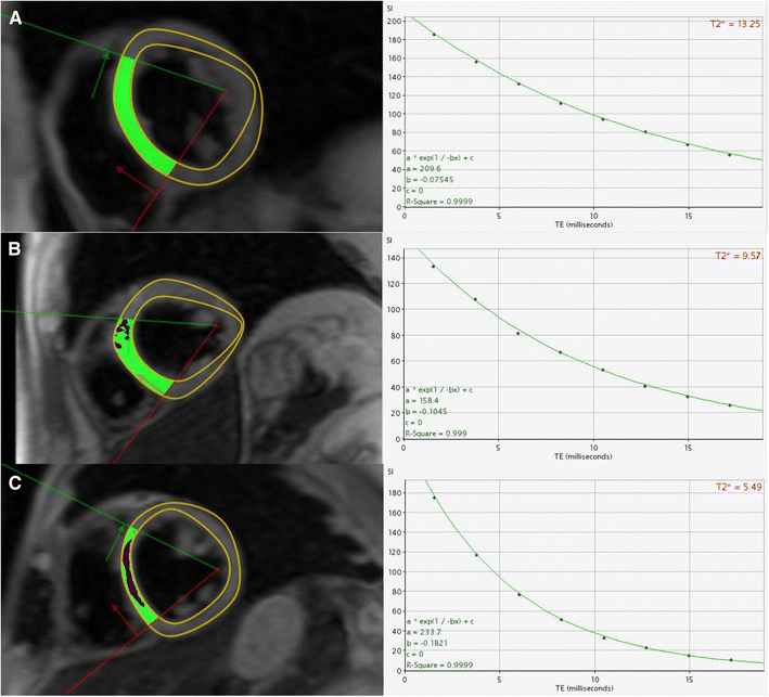 T2 mapping and T2* imaging in heart failure | SpringerLink