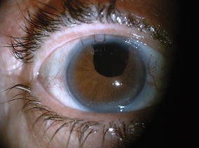 Pupil occlusion due to a large dislocated Soemmering ring in an aphakic ...