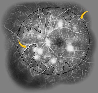 Extended targeted retinal photocoagulation versus conventional pan ...