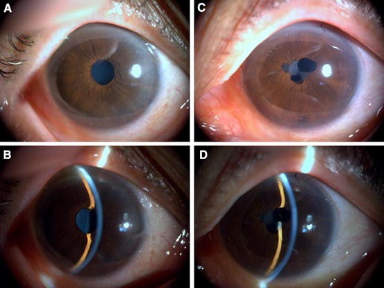 Successful recovery from misdirection syndrome in nanophthalmic eyes by ...