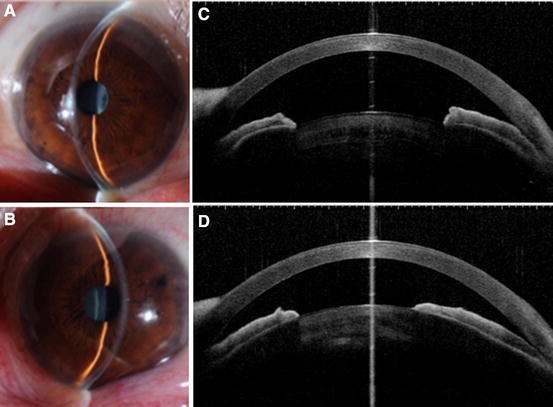 Successful recovery from misdirection syndrome in nanophthalmic eyes by ...