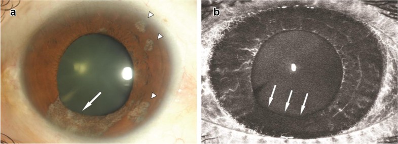 Clinical features of anterior uveitis caused by three different herpes ...