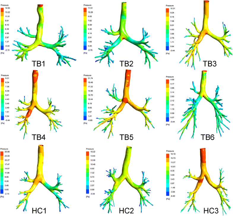 Airflow in Tracheobronchial Tree of Subjects with Tracheal Bronchus ...