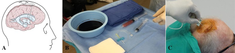 Human intracerebroventricular (ICV) injection of autologous, non ...