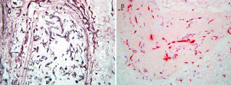 Isavuconazole in a Successful Combination Treatment of Disseminated ...