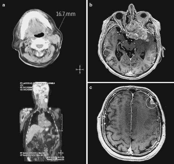 Aggressive and malignant prolactin pituitary tumors: pathological ...