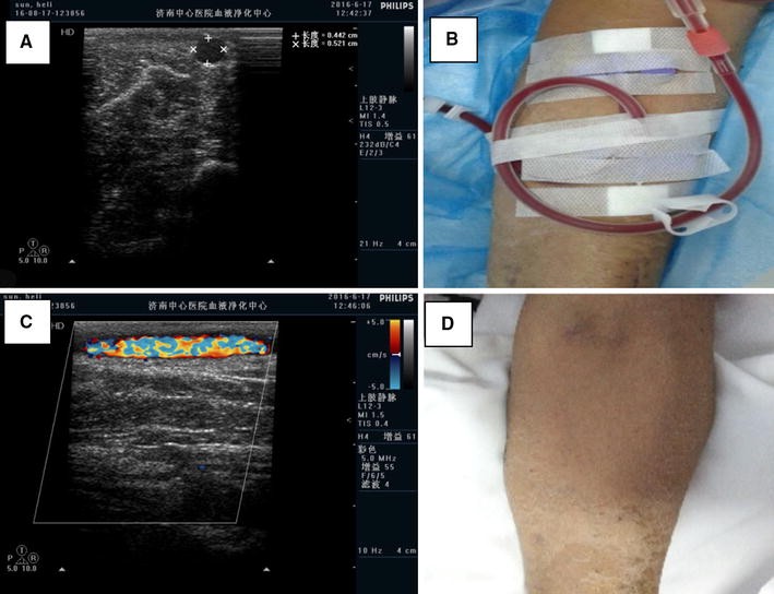 Early use of autogenous arteriovenous fistula in patients with urgent ...
