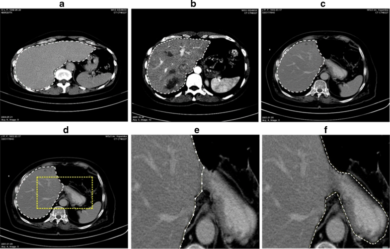 Automatic Liver Segmentation from 2D CT Images Using an Approximate ...