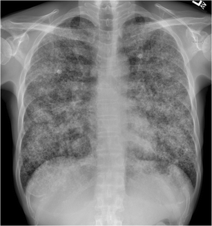 Lung Adenocarcinoma with Miliary Metastases and Left Femur Pathologic ...