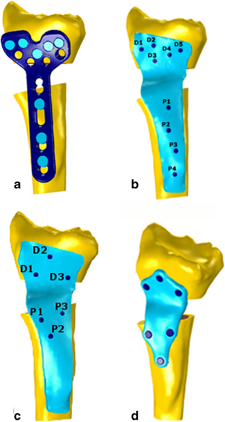 Biomechanical considerations in the design of patient-specific fixation ...
