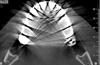 Metal and motion artifacts by cone beam computed tomography (CBCT) in ...
