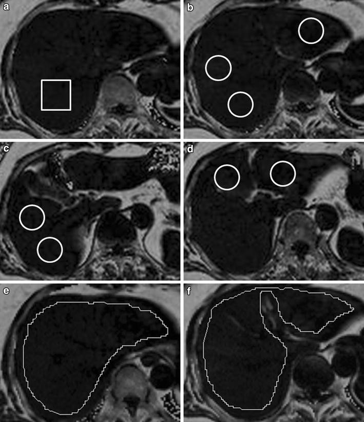 Hepatic fat quantification using the proton density fat fraction (PDFF ...