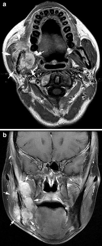 Radiation-induced sarcomas of the head and neck in post-radiation ...