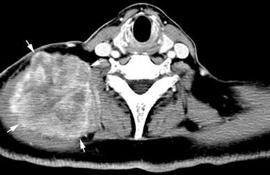 Radiation-induced sarcomas of the head and neck in post-radiation ...