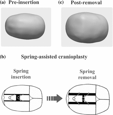 Statistical shape modelling to aid surgical planning: associations ...