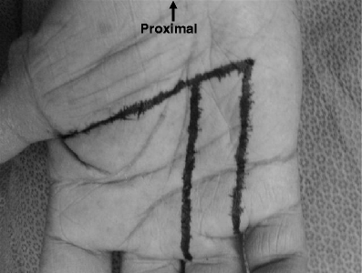 The Clinical Application of Kaplan’s Cardinal Line as a Surface Marker ...