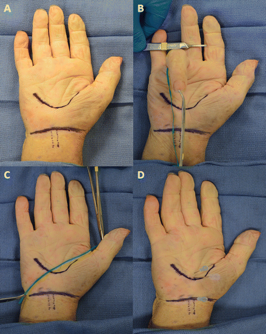 The Cup of Diogenes: a fixed anatomical landmark for carpal tunnel ...