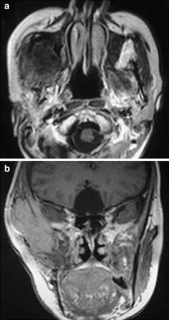 Computed tomography and magnetic resonance imaging of lesions at ...