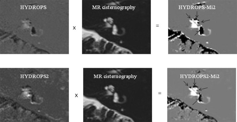 Visualization of endolymphatic hydrops with MR imaging in patients with ...