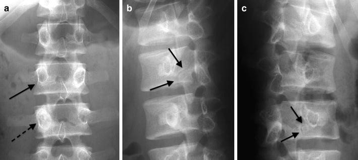 Spondylolytic spondylolisthesis: various imaging features and natural ...
