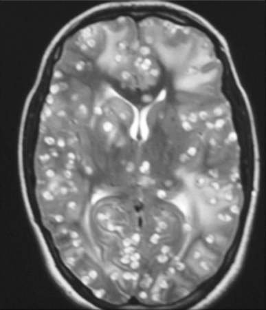A comprehensive review of imaging findings in human cysticercosis ...