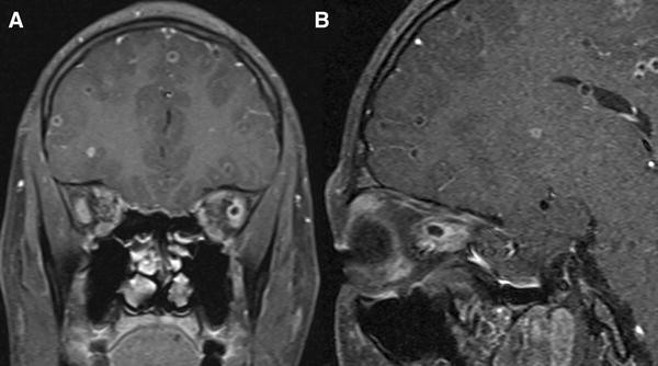 A comprehensive review of imaging findings in human cysticercosis ...