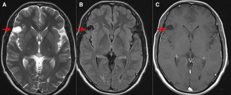 A comprehensive review of imaging findings in human cysticercosis ...