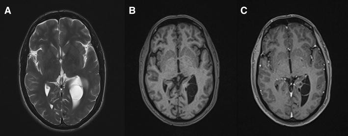 A comprehensive review of imaging findings in human cysticercosis ...