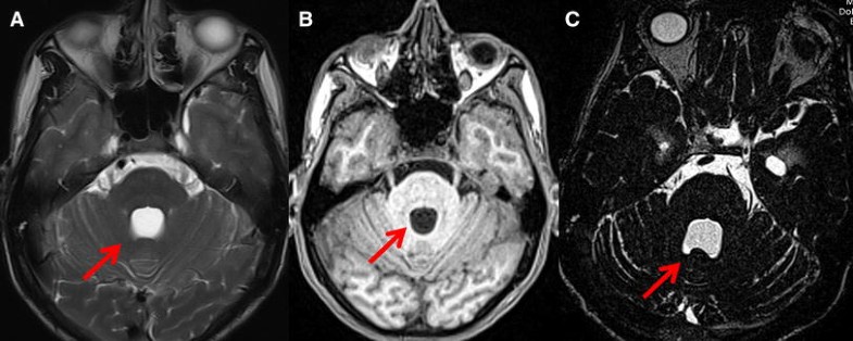A comprehensive review of imaging findings in human cysticercosis ...