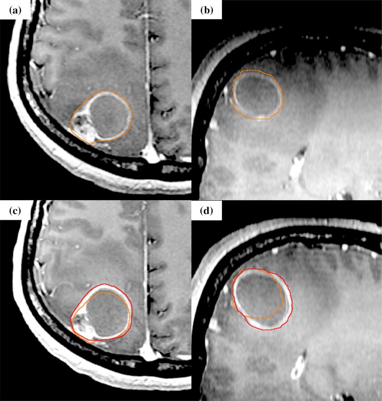 MRI appearance change during stereotactic radiotherapy for large brain ...