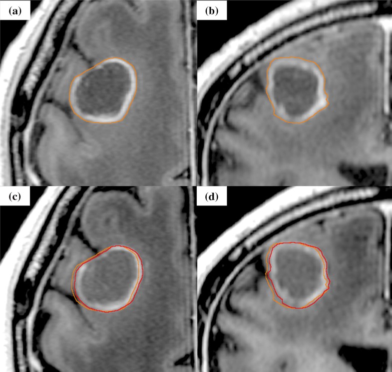 MRI appearance change during stereotactic radiotherapy for large brain ...