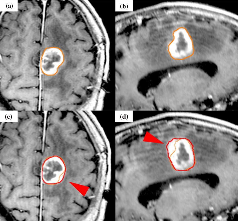 MRI appearance change during stereotactic radiotherapy for large brain ...