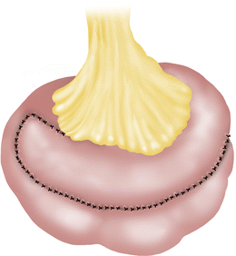 How I Do It: Side-to-Side Isoperistaltic Strictureplasty for Extensive ...